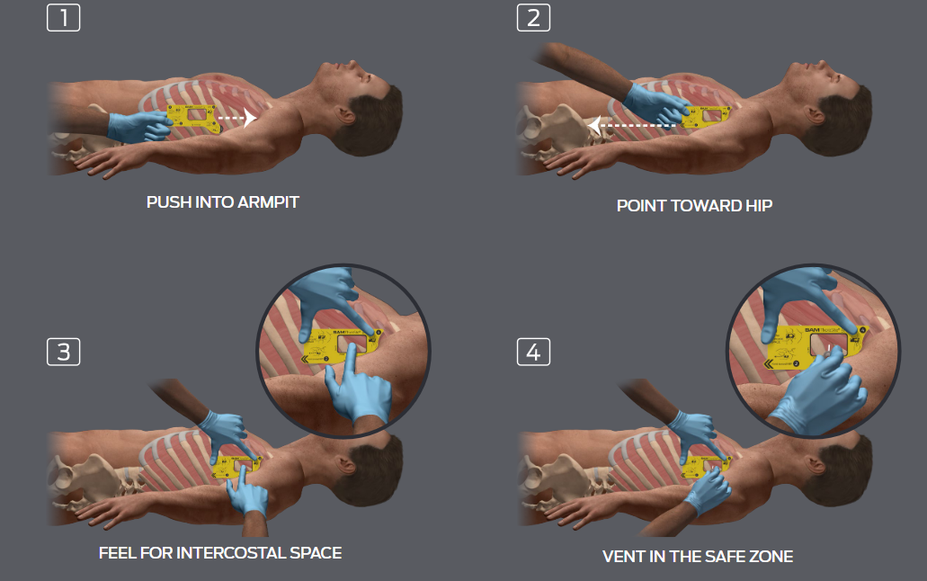 SAM ThoraSite | MEAD Medical